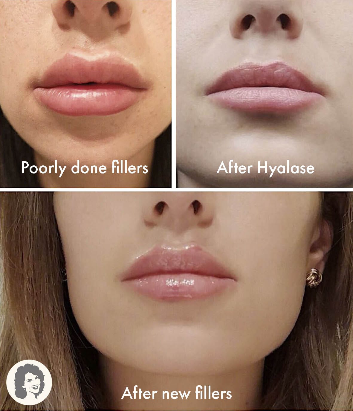 Hyalase " Dr Nina | Göteborg