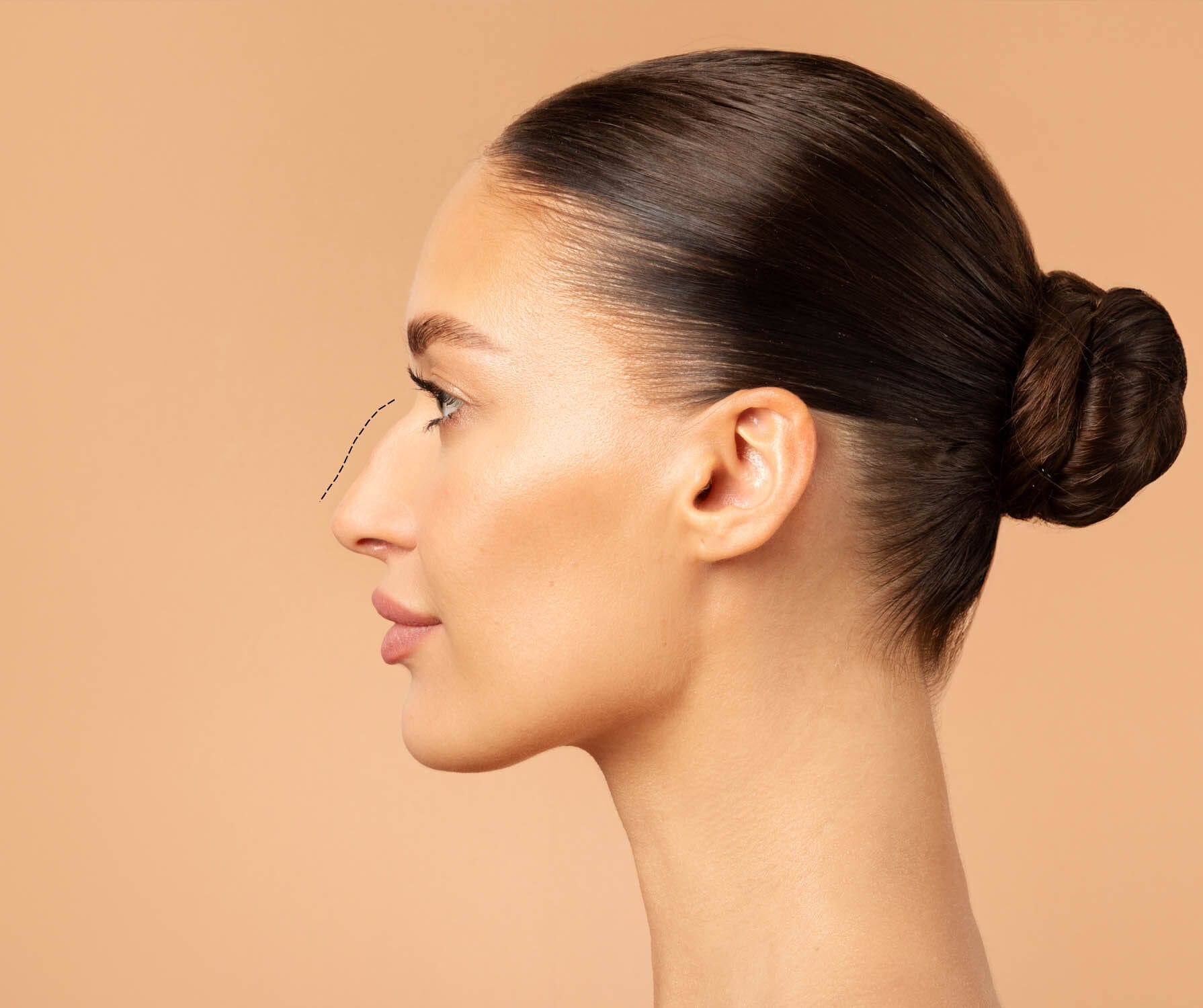 Nose correction Gothenburg | Fillers Nose | Fillers in the Nose